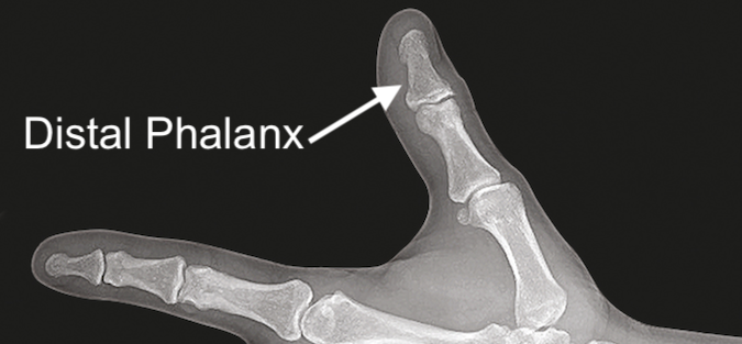 Thumb Distal Phalanx Anatomy | Anatomic Structures at Risk